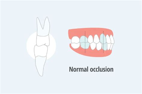 Occlusion Importance Types And Treatment Options Smilepath Australia