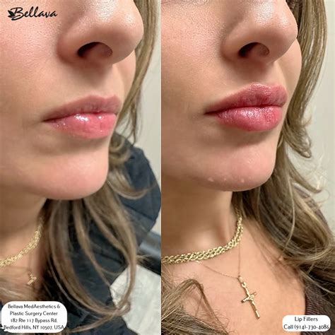 Lip Filler Migration Causes Symptoms And Solutions