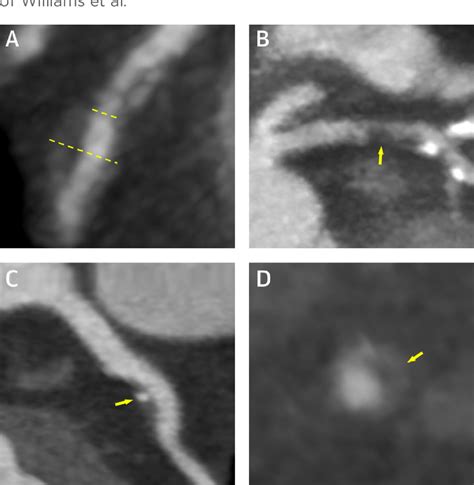 Figure From Non Invasive Imaging Of High Risk Coronary Plaque The Role Of Computed Tomography