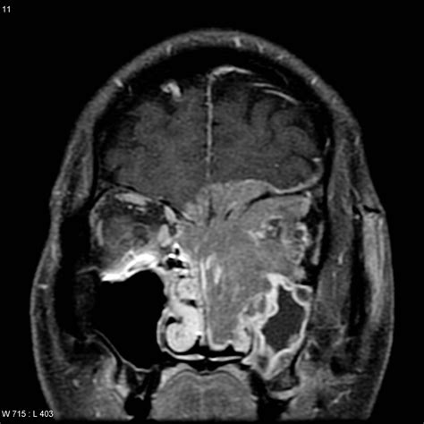 Esthesioneuroblastoma Mri