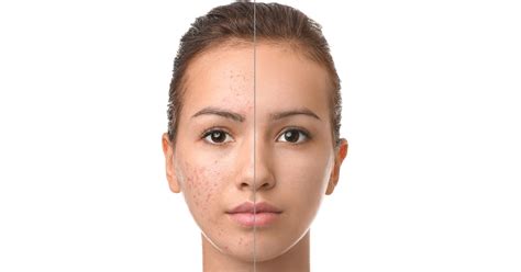 Best Treatments To Eliminate Acne Scarring Santé A Toast To Your Health