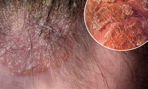 Eczema Hairline