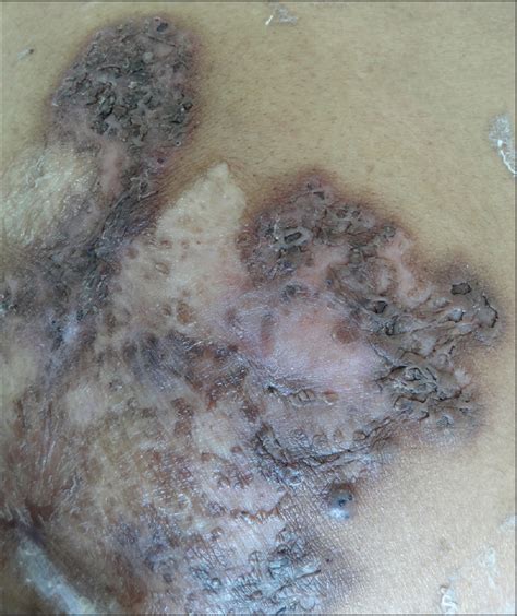 Superficial Granulomatous Pyoderma A Great Mimicker Indian Journal