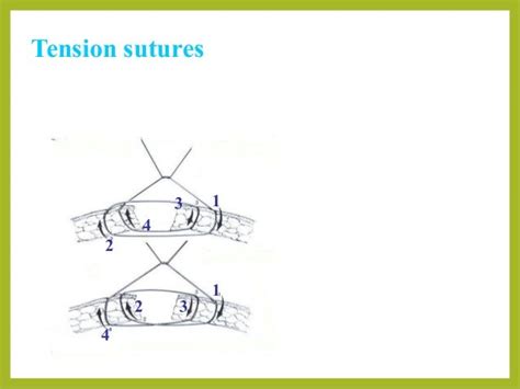 Basic Suture Patterns