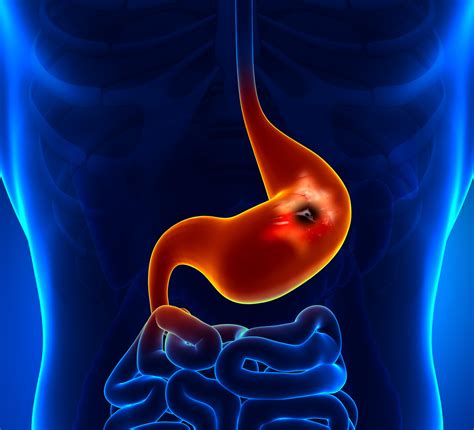 Stomach Ulcer Peptic Ulcer Medlineplus