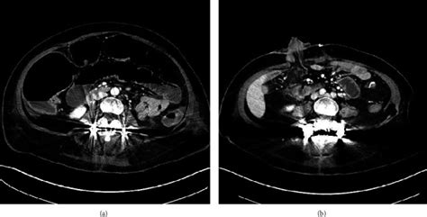 Colectomy Complicated By High Output Ileostomy Managed In A Virtual Hybrid Hospital At Home