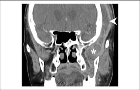 An 84 Year Old Female Patient With A Left Masticator Space Abscess