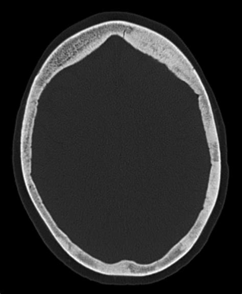 Imaging Of Focal Calvarial Lesions Clinical Radiology