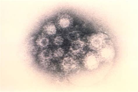 ‘tomato Flu Outbreak In India Heres What It Really Is