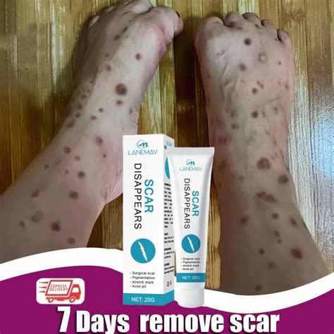 Mosquito Bite Scar Removal Cream Keloid Scar Removal Stretch Mark