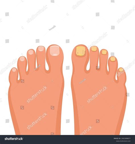 Nail Disease Onychomycosis Concept Fungal Nail Stock Vector Royalty