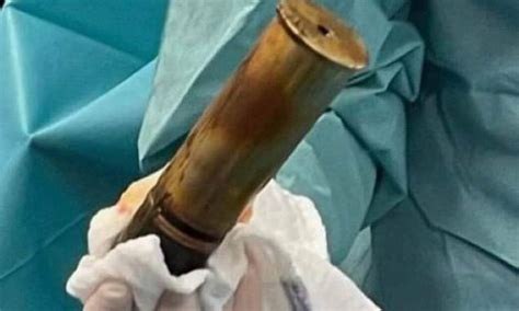 French Man Sparks Hospital Evacuation After Arriving With A WWI