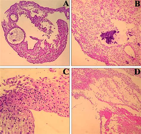Pathology Findings A Pseudodecidualized Endometrium Presence Of