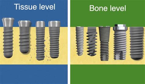Straumann® Tissue Level Implants Имплантация зубов в Москве Клиника