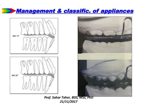 Skeletal Class Ii Mixed Dentition By Prof Sahar Taher