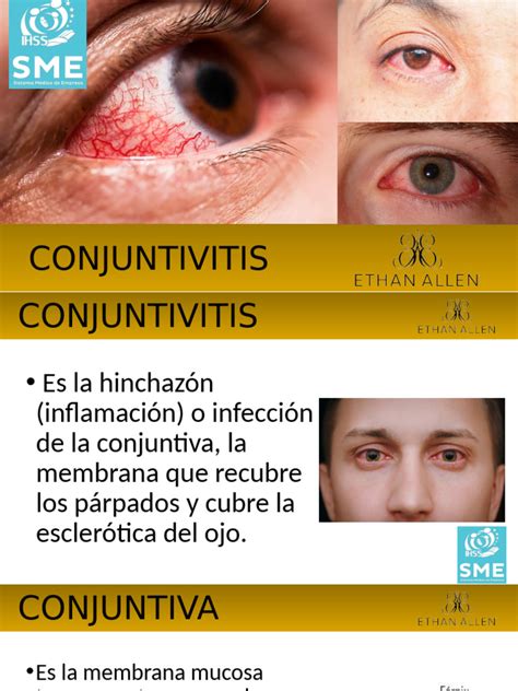Conjuntivitis Pdf