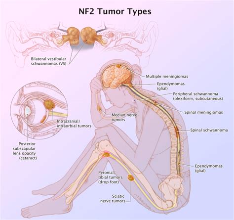 Fileneurofibromatosis Type Ii Tumor Typespng Wikimedia Commons