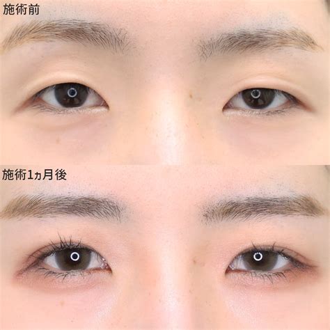 【埋没法】でナチュラルにイメージチェンジ｜症例写真・ビフォーアフター｜美容整形･美容外科のtaクリニックグループ