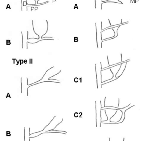 Choledochal Cyst Was Described According To Todanis Classification