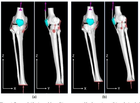 Figure 1 From Simulating Knee Stress Distribution Using A Computed Tomography Based Finite