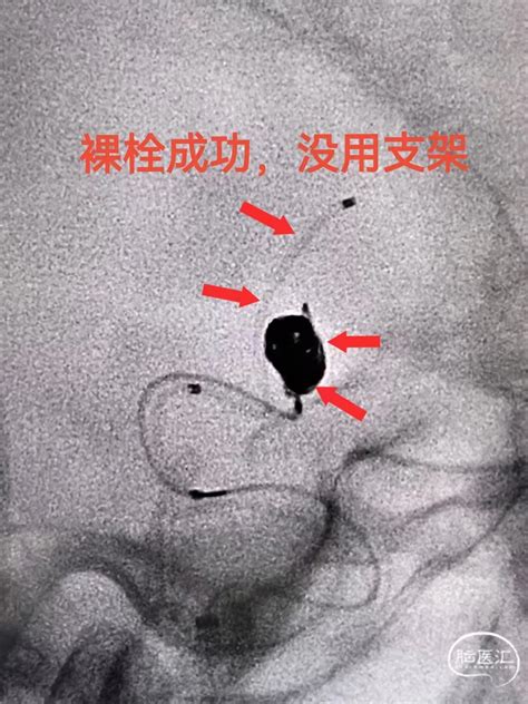 郭再玉教授：颅内出血动脉瘤栓塞术后复发再治疗病例分享 脑医汇 神外资讯 神介资讯