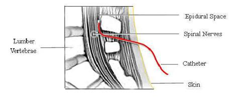 A Typical Epidural Injection Procedure Download Scientific Diagram