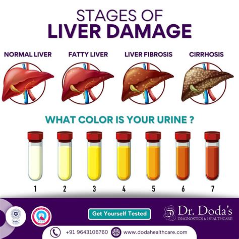 Dr Dodas Healthcare On Linkedin Fibrosisquistica Fibrosis