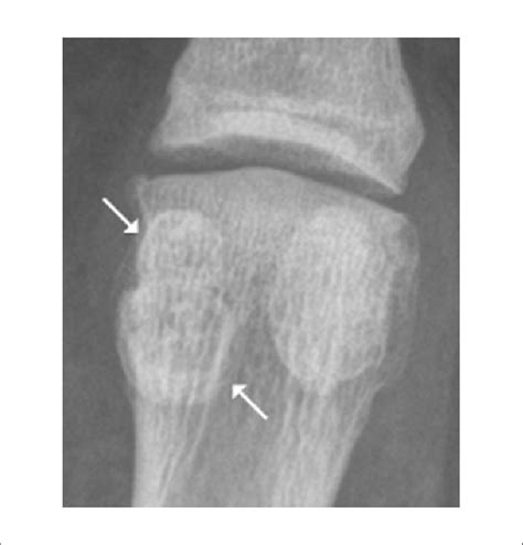 Radiograph Of The Hallux Metatarsophalangeal Joint Demonstrating A