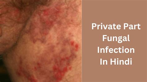 Private Part Fungal Infection In Hindi कारण लक्षण और बचाव के उपाय जानें