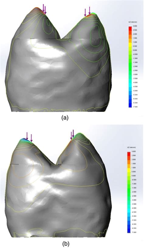 Simulated Deformation Of An Artificial Tooth Calculated Using Fem A