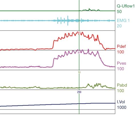 Urodynamic And Physiologic Patterns Associated With The Common Causes Of Neurogenic Bladder In