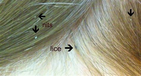 Help For Head Lice