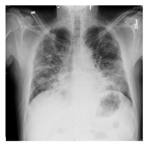 Cxr Frontal View Before Treatment Showing Bilateral Interstitial