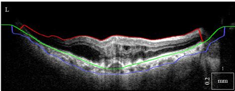 the algorithm correctly interpolated over the drusen finding a close