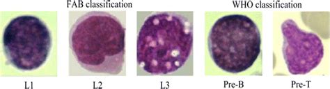 A Comparison Between Different Type Of Lymphoblast Suffering From