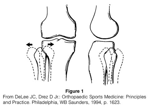Proximal Tibiofibular Joint Dislocation Oklahoma City