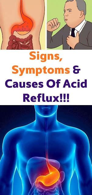 Signs Symptoms And Causes Of Acid Reflux Healthmgz