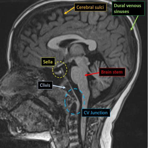 Midsagittal Section Of MRI Brain Showing BLIND SPOTS References
