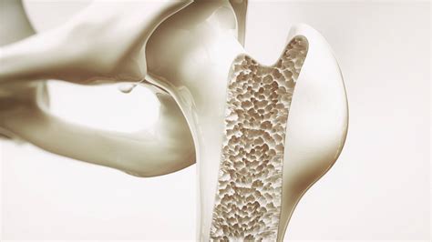 Raas Inhibitors Do Not Increase Fracture Risk Osteoporosis In
