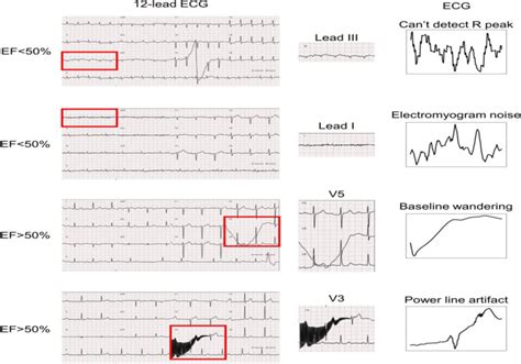 Various Types Noises In Ecg Waves Are Considered Download Scientific