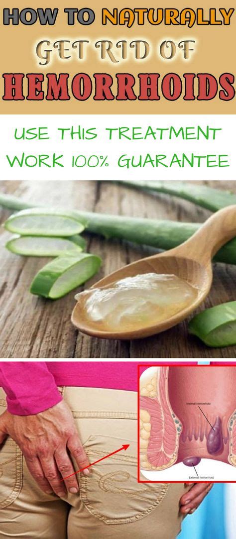 Home Remedies For Hemorrhoids Treating Hemorrhoids The Forever Way