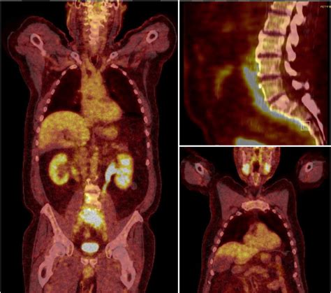 PeT CT Scan Of A Patient Later Histologically Diagnosed With A
