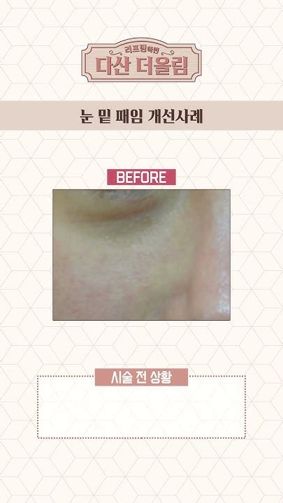 눈 밑 패임 효과 좋은 인기 시술 비수술눈밑재배치 사례 확인🤗 Youtube