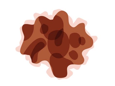 怖いホクロのがん『メラノーマ 悪性黒色腫 』の見分け方を皮膚科医が解説 Lumedia ルメディア
