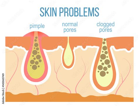 Skin Problems Acne Pimples And Clogged Pores Skin Pores Close Up
