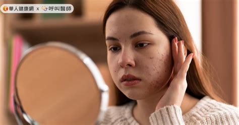 孕婦喝綠豆水，可以消除痘痘？中醫師：「喝這些」取代綠豆湯助抗痘 華人健康網 專業即時優質的健康新聞及資訊分享平台業即時優質的健康新聞及