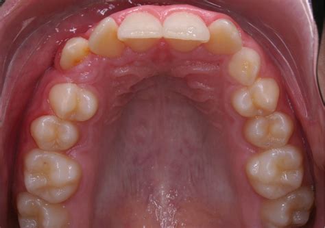 Barnett Orthodontics Blog Invisalign Braces And More In Akron Ohio