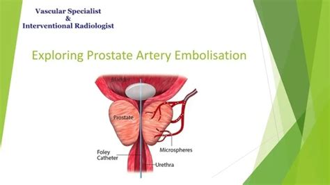 Ppt Exploring Prostate Artery Embolisation Powerpoint Presentation
