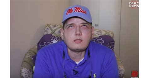 Мъжът с първото изцяло трансплантирано лице вече живее нормално видео