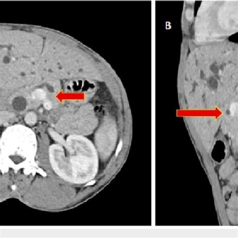 The Coronal A And Sagittal B Views Of The Preoperative Contrast